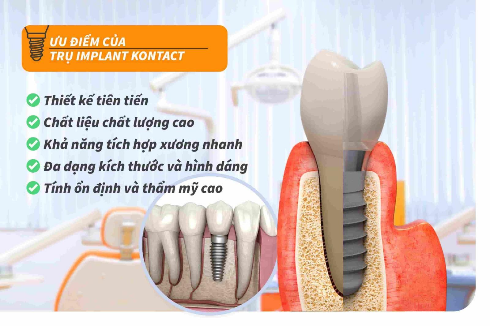 Trụ Implant Kontact (Pháp) - Chi phí và ưu điểm | Up Dental